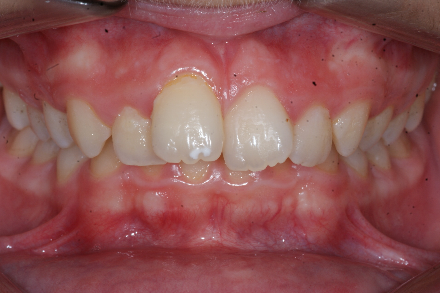 Surplomb vertical - étude de cas #8 - Orthodontie Sherbrooke