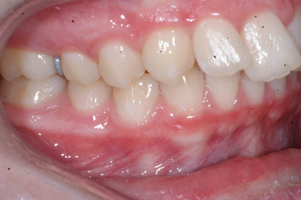 Chevauchement - étude de cas #8 - Ortho Sherbrooke