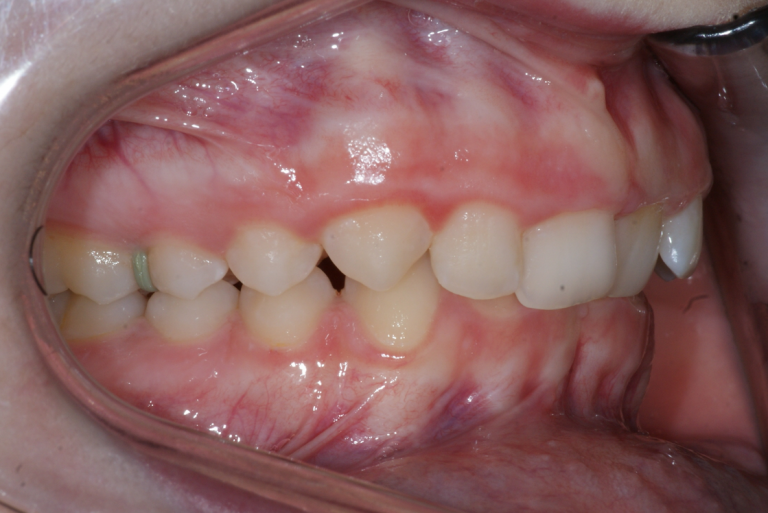 Surplomb vertical - Étude de cas 2 - Orthodontie Sherbrooke