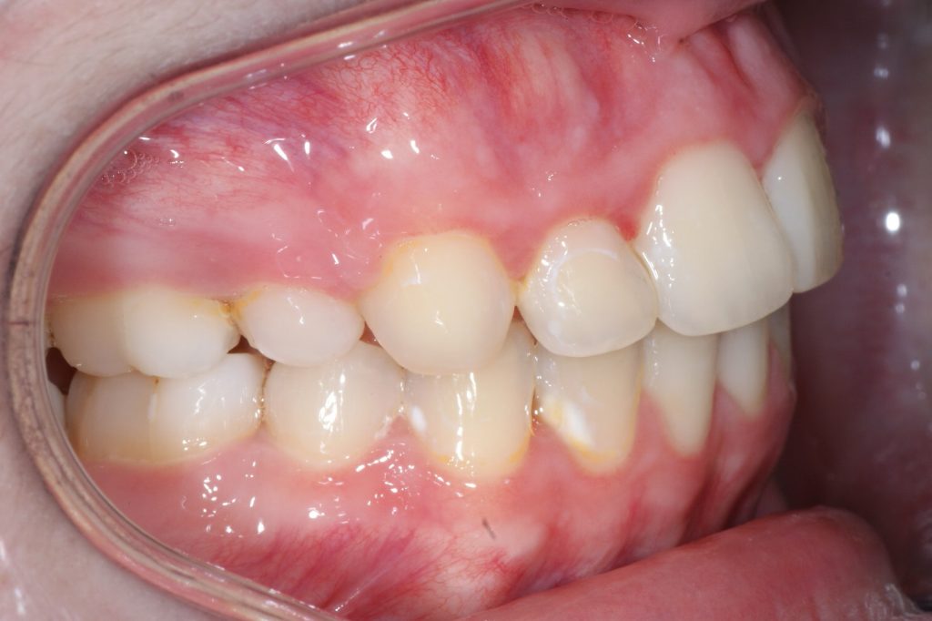 Chevauchement, étude de cas #6 - Orthodontie Sherbrooke