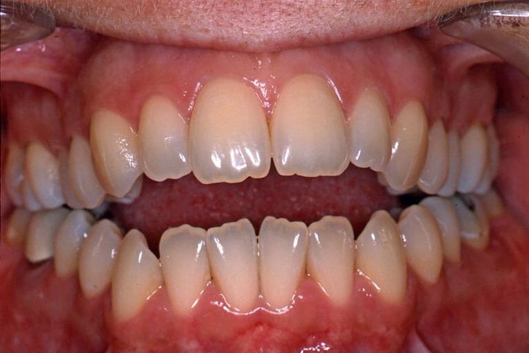 Béances occlusales - Étude de cas 1 - Orthodontie Sherbrooke